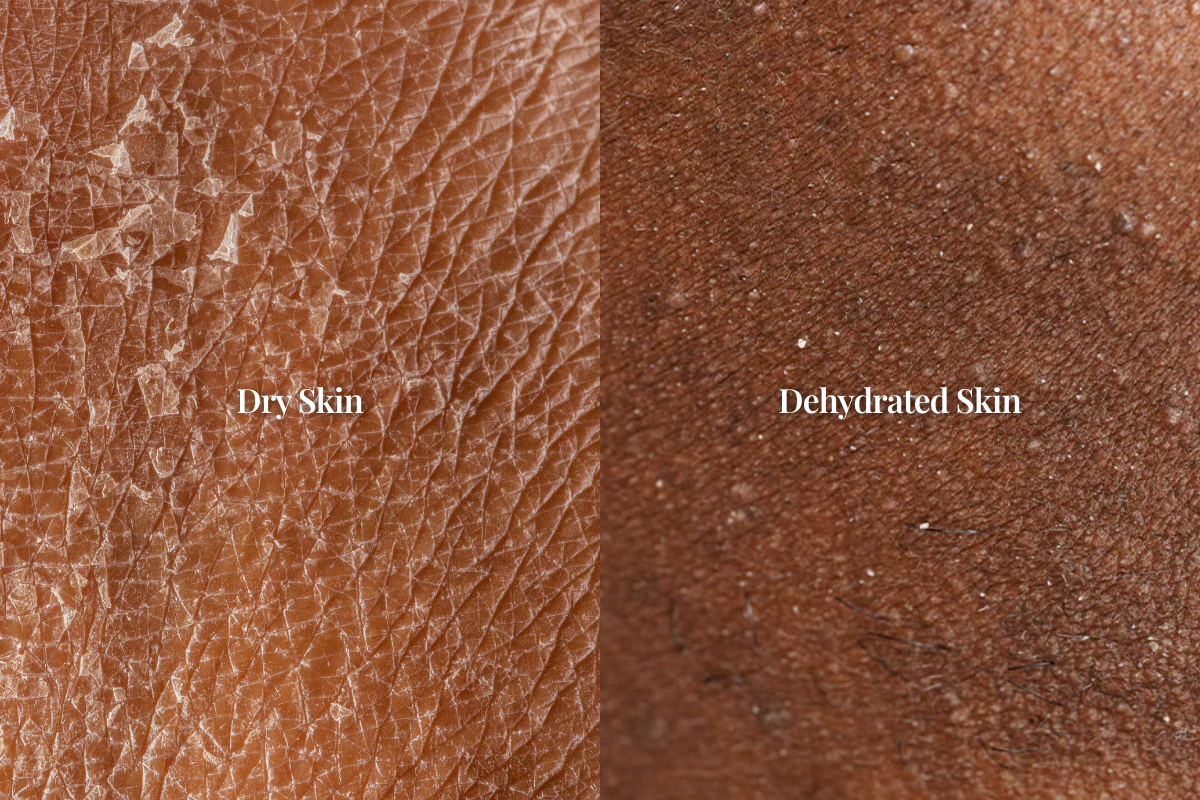 Dryness & Dehydrated Skin: Causes, Solutions & Hydration Rituals ...